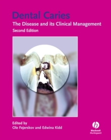 Dental Caries: The Disease and Its Clinical Management by Fejerskov ...